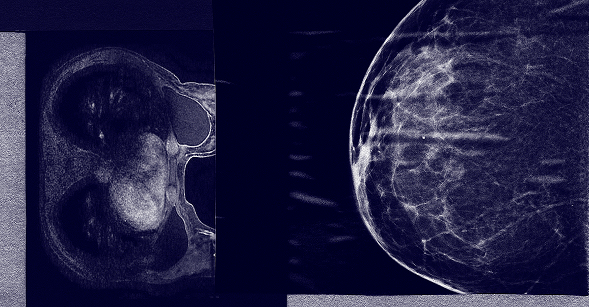 Mammogram or MRI: Which One Should You Choose?